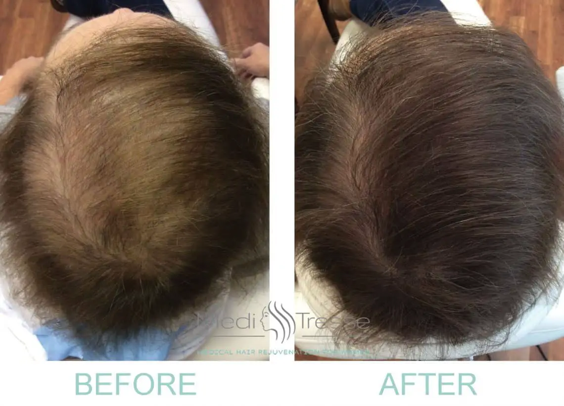 PRP for Hair Loss: Growth Results, Costs & Side Effects - Bald & Beards PRP for Hair Loss: Growth Results, Costs & Side Effects - Bald & Beards